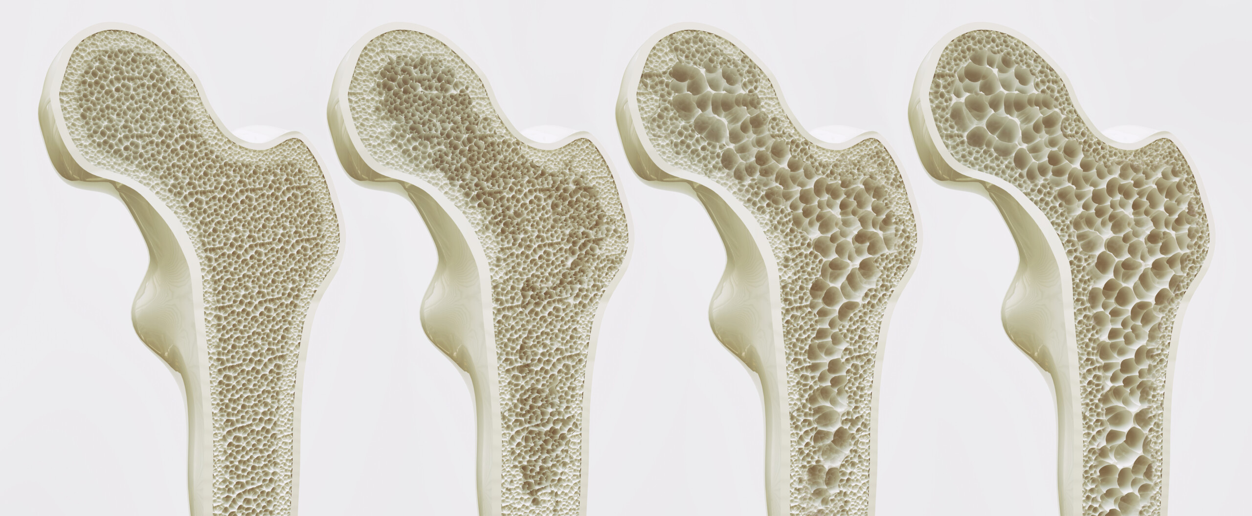 What is Osteoporosis? - Rush Memorial Hospital